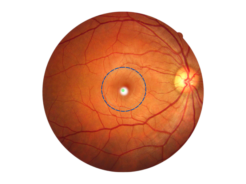 Light-based therapy for early Age-related Macular Degeneration